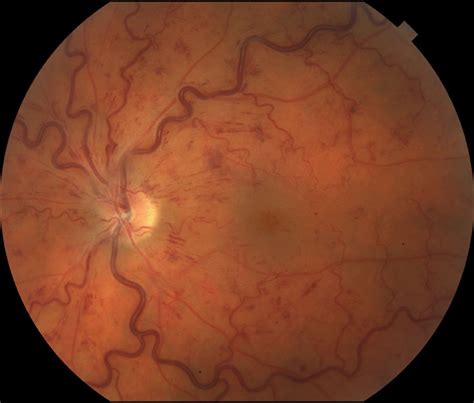 Retinal Vein Occlusion Treatment Best Retinal Specialists In New York