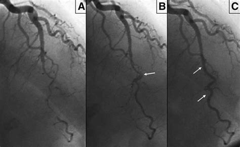 Coronary Artery Tortuosity In Spontaneous Coronary Artery Dissection