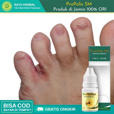 Jual Obat Kutu Air Obat Gatal Di Sela Jari Kaki Tangan Kaki Obat Kutu