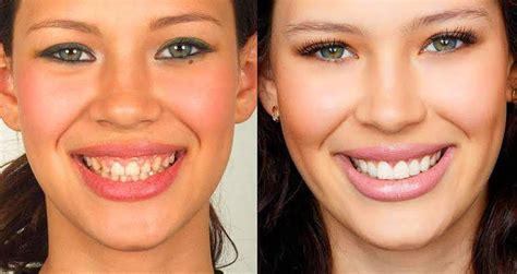 Lentes de contato dental O que é quanto custa e antes e depois