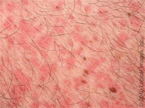 Skin Lesions Flashcards Quizlet