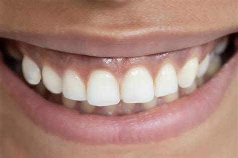 What Do Healthy Gums Look Like Pictures Action Plan