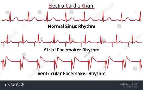 Set Ecg Common Abnormalities Atrial Vs Stock Vector Royalty Free