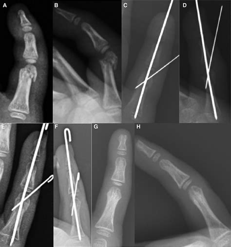 Frontiers Clinical Outcomes Of Closed Displaced Phalangeal Neck
