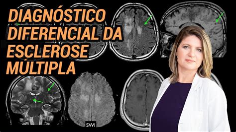 DIAGNÓSTICO DIFERENCIAL DA ESCLEROSE MÚLTIPLA NÃO CONFUNDA DOENÇAS