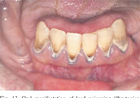 Figure 13 From Pigmented Lesions Of The Oral Mucosa And Perioral