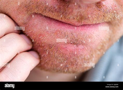 Red Itchy Rash On Forehead