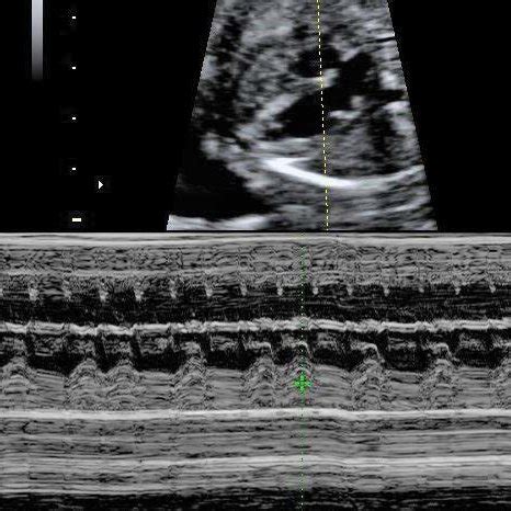 Fetal Echocardiogram In A 24 Weeks Pregnancy M Mode Shows Abnormal