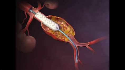Tratamiento Endovascular Del Aneurisma De Aorta Abdominal Youtube