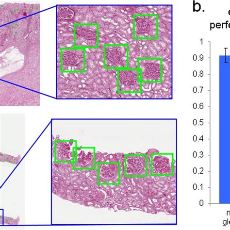 Examples And Results From Glomerular Detection In Human Wsis Using