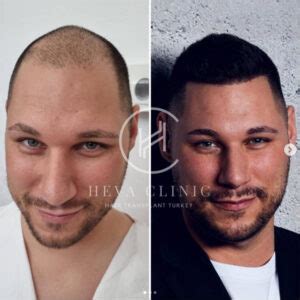 Wie lange hält eine Haartransplantation Heva Clinic Türkei
