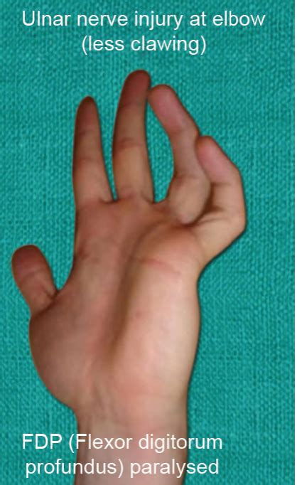 Ulnar Nerve Lesions Causes Diagnosis Ulnar Nerve Mi Pro Co Uk