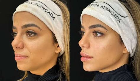 Key Alves passa por harmonização facial veja antes e depois