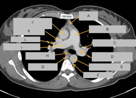 Radiology Cross Sectional Cardiac Anatomy Flashcards Quizlet