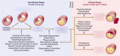 Atherosclerosis Diagram