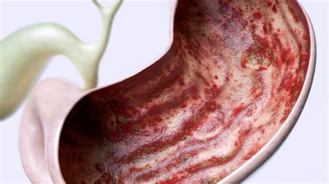 Los 7 Tipos De Gastritis Muy Salud