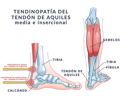 Tendinopatía del tendón de aquiles qué es y cómo tratarla