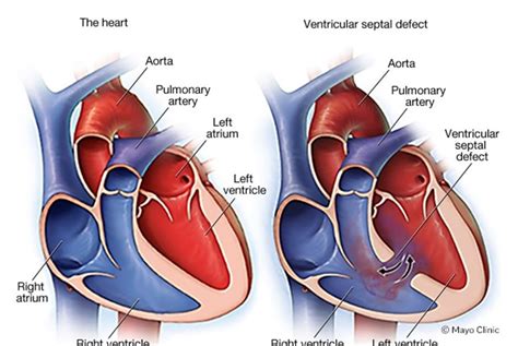 Procedures Point Ventricular Septal Defect VSD