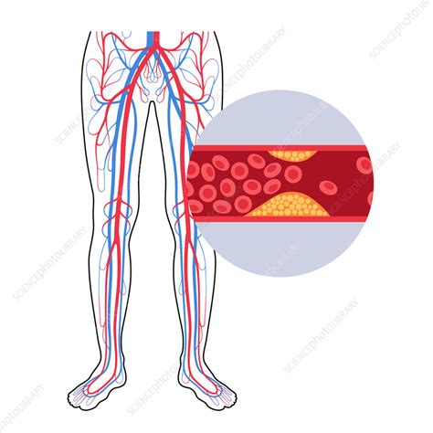 Peripheral Artery Disease Illustration Stock Image F035 4238