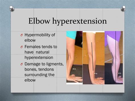 PPT Elbow Injuries PowerPoint Presentation ID 2188505