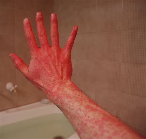 List 101 Pictures Why Do I Have A Rash On My Forearm Excellent