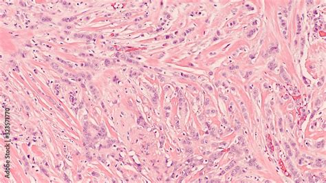 Invasive Ductal Carcinoma Histology