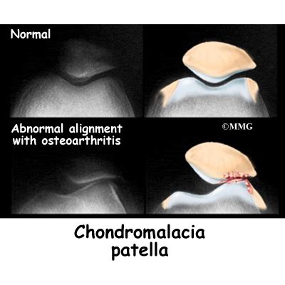 Chondromalacia Patella EOrthopod