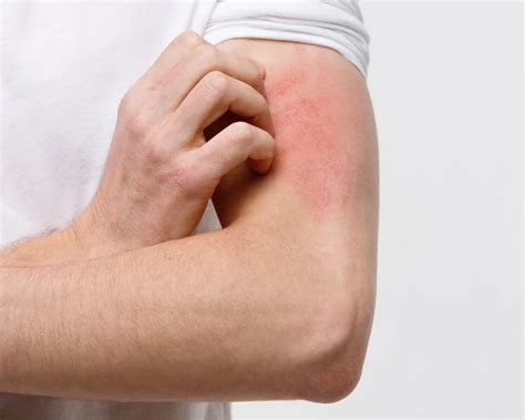 Scabies erkennen und behandeln Hauterkrankung Krätze