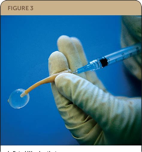 Figure From Bartholin Duct Cyst And Gland Abscess Office Management