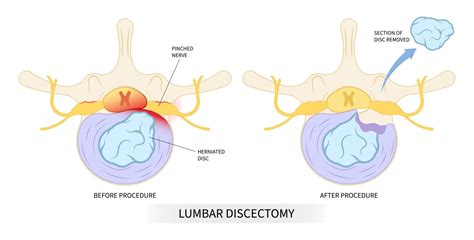 What Is The Difference Between Forminotomy Discectomy And Laminectomy