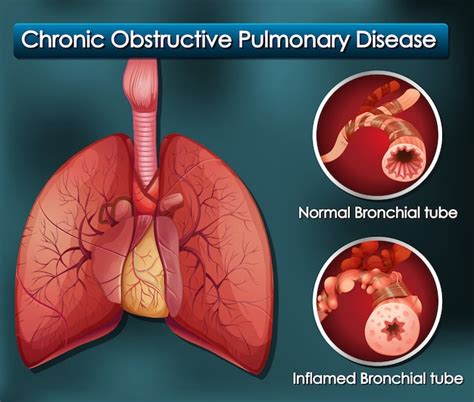 Free Vector Diagram Showing Chronic Obstructive Pulmonary Disease