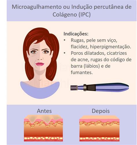 Microagulhamento em Brasília como funciona essa técnica para a pele