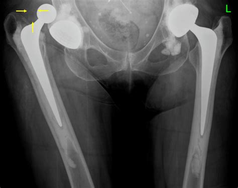Complication Of Intraprosthetic Dislocation Of Dual Mobility Hip