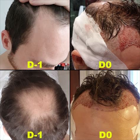La Greffe De Cheveux Arnaud Knobloch