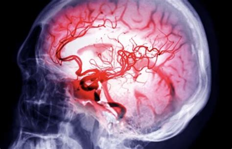 Como tratar um aneurisma na cabeça Aneurisma Cerebral
