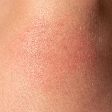 allergie sur le corps humain et rougeur d une piqûre de guêpe 14377763