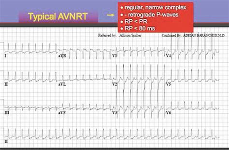 Av Nodal Reentrant Tachycardia Ecg