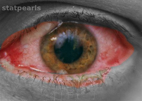 Figure Bacterial Conjunctivitis Image Courtesy O Chaigasame
