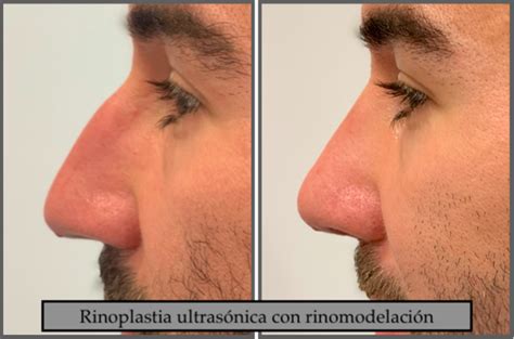 Rinoplastia Masculina Sendagrup