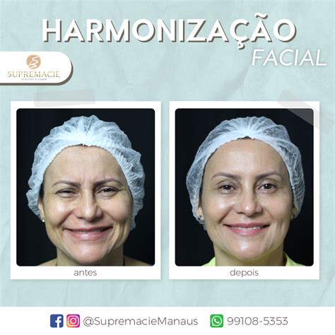 Já pensou em dar adeus para as marcas de expressão A Angela não