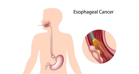 Esophageal Cancer What Are Risk Factors How To Prevent