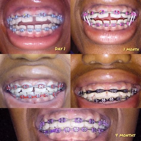 Braces Glow Brace Face Braces Elastics Braces And Glasses Fake