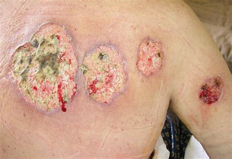 Pyoderma Gangrenosum DermRounds Dermatology Network