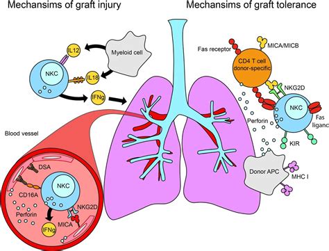 Natural Killer Cells In Lung Transplantation Thorax