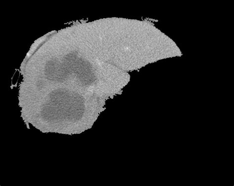 image processing fuzzy c means for tumor segmentation using matlab stack overflow