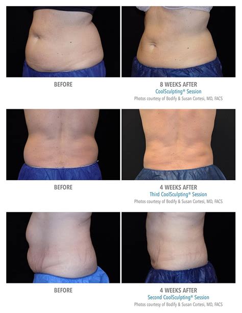 Pin On CoolSculpting