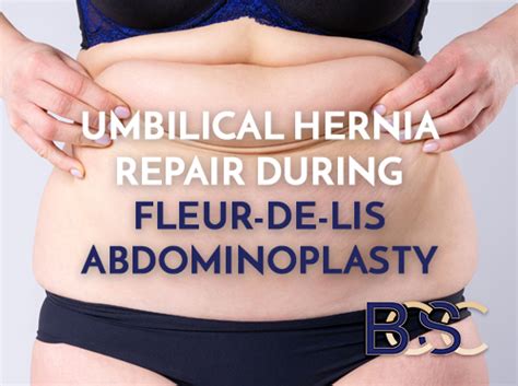Umbilical Hernia Repair During Fleur De Lis Abdominoplasty Surgery