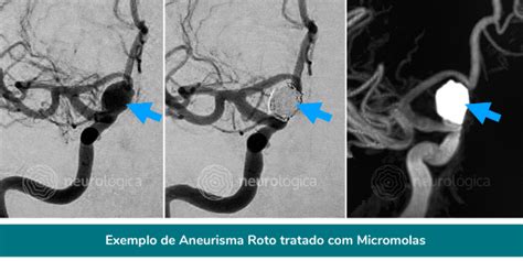 Aneurisma cerebral prevenção diagnóstico e tratamento