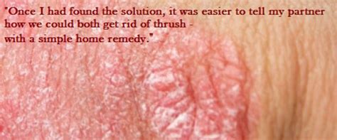 Home Remedies For Itching In Private Parts Female Lanipod