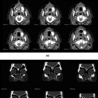 Axial A And Coronal B View Of Computed Tomography Scan Of The